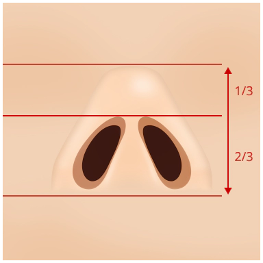 MINE Plastic Surgery | alarplasty to reduce wide nostrils