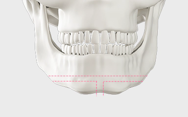 Facial Contouring Korea – Mine Clinic | cheekbone, jaw, chin