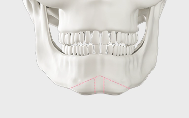 Facial Contouring Korea – Mine Clinic | cheekbone, jaw, chin