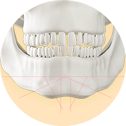 MINE Plastic Surgery | Genioplasty | for long/short chins"