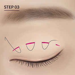 MINE Plastic Surgery | double eyelid | Incision method for thicker eyelids