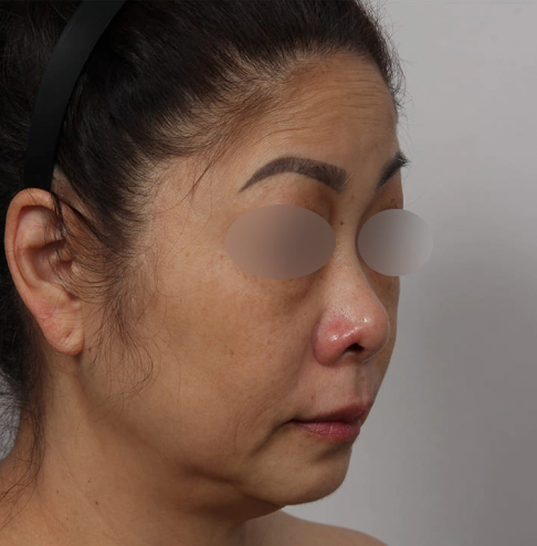 Korean Face Lift for complete natural antiaging | MINEps