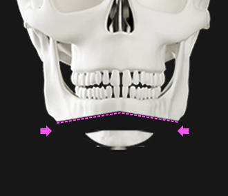 MINE Plastic Surgery | Genioplasty | for long/short chins"