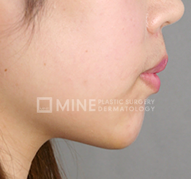 MINE Plastic Surgery | Genioplasty | for long/short chins"