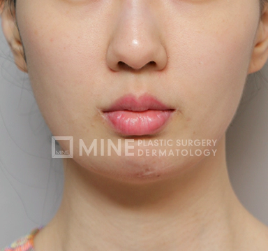 MINE Plastic Surgery | Genioplasty | for long/short chins"