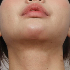 Korean Jawline Lifting : mini neck lift for sagging - MINEps
