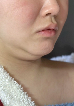 Korean Jawline Lifting : mini neck lift for sagging - MINEps