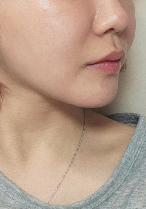 Korean Jawline Lifting : mini neck lift for sagging - MINEps