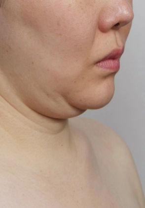 Korean Jawline Lifting : mini neck lift for sagging - MINEps