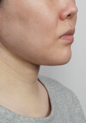 Korean Jawline Lifting : mini neck lift for sagging - MINEps