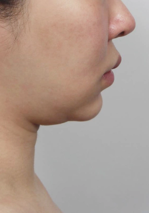 Korean Jawline Lifting : mini neck lift for sagging - MINEps