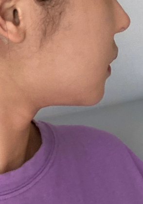 Korean Jawline Lifting : mini neck lift for sagging - MINEps