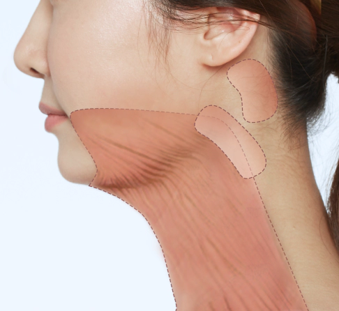 Korean Jawline Lifting : mini neck lift for sagging - MINEps