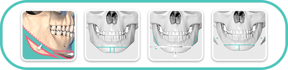 MINE Plastic Surgery | Mandibular reduction for Square Jaw