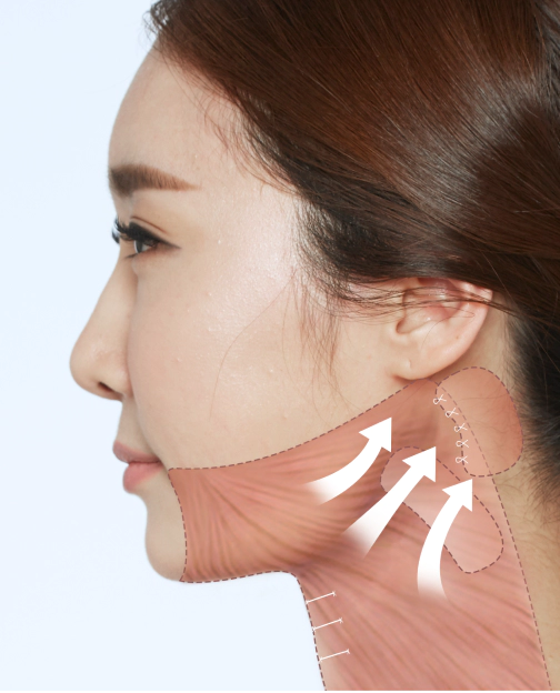 Korean Jawline Lifting : mini neck lift for sagging - MINEps