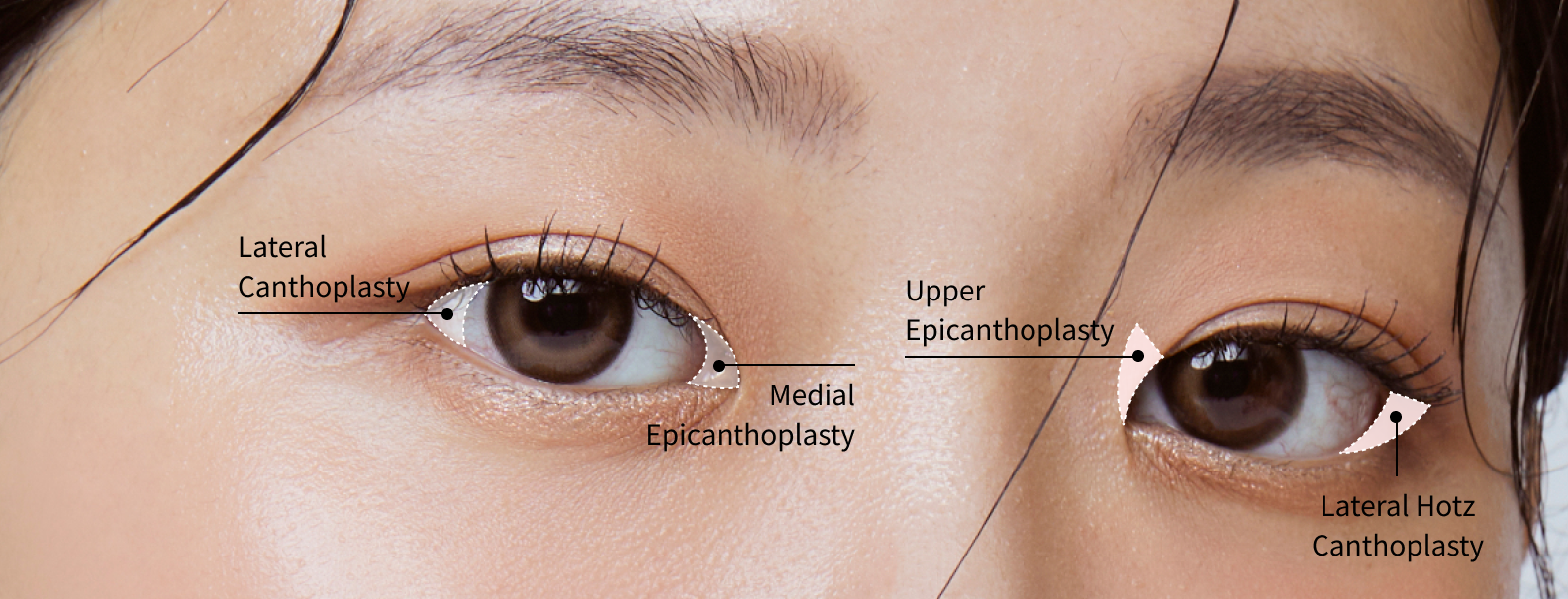 MINE Plastic Surgery | Canthoplasty | Widen your eyes with canthoplasty