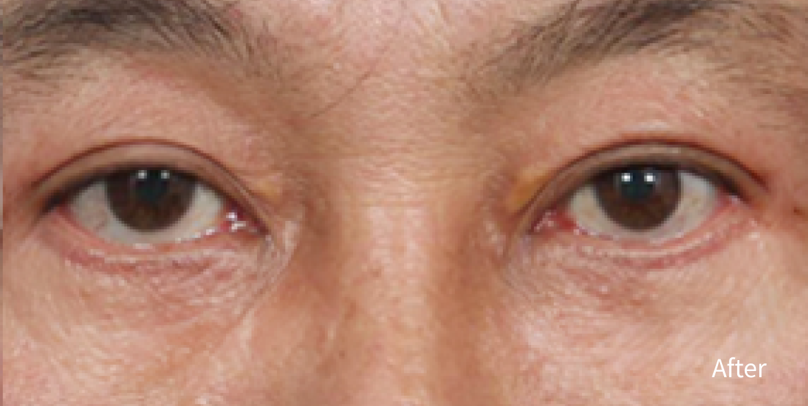 MINE Plastic Surgery | lower blepharoplasty | Lower Eye Bag Removal