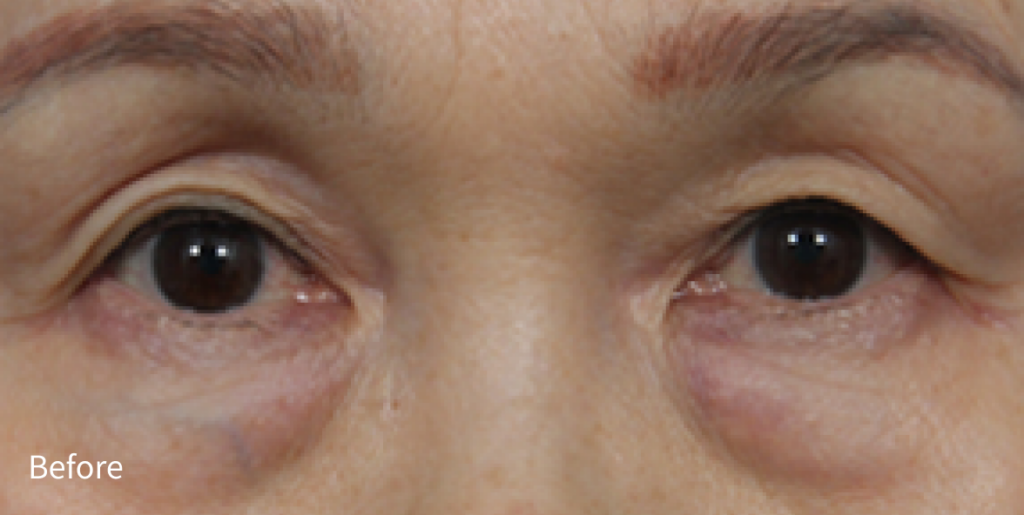 MINE Plastic Surgery | lower blepharoplasty | Lower Eye Bag Removal