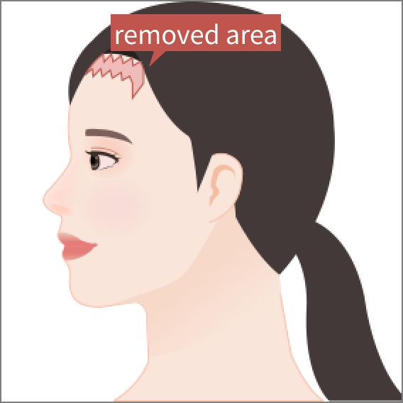 MINE Plastic Surgery | Forehead Reduction for high hairlines
