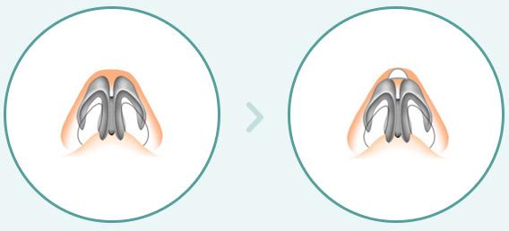 Wide Nose Rhinoplasty Surgery Korea | MINE Plastic Surgery