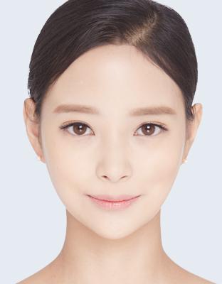 Square Jaw Reduction Surgery Korea | MINE Plastic Surgery