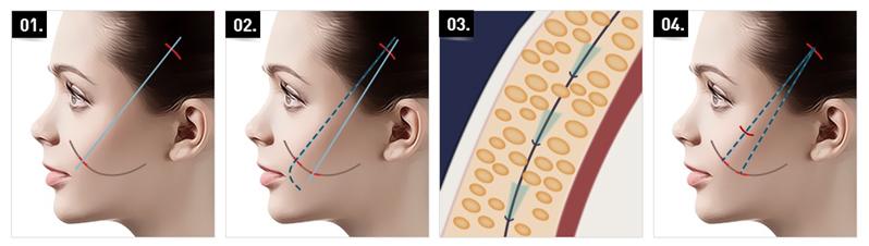 MINE Plastic Surgery | Thread Lifting in Korea
