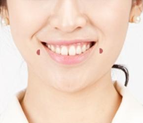 Dimple Surgery Korea - Mine Clinic | Cute dimple points