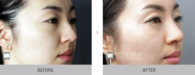 MINE Plastic Surgery | Korean Nose Surgery | rhinoplasty
