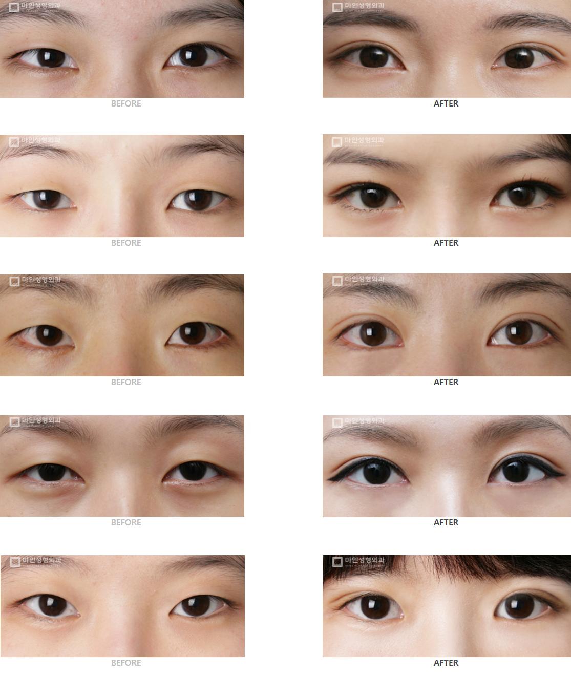 Revision Eye Surgery Clinic Korea | Fix loose undone lines