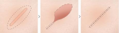 Scar Removal & Revision Surgery Korea | MINE Plastic Surgery