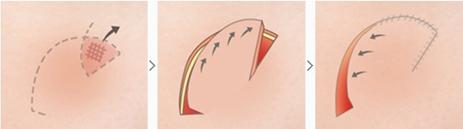 Scar Removal & Revision Surgery Korea | MINE Plastic Surgery