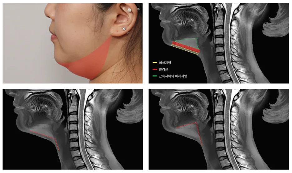 Guide to Double Chin Removal Surgery | MINE Plastic Surgery