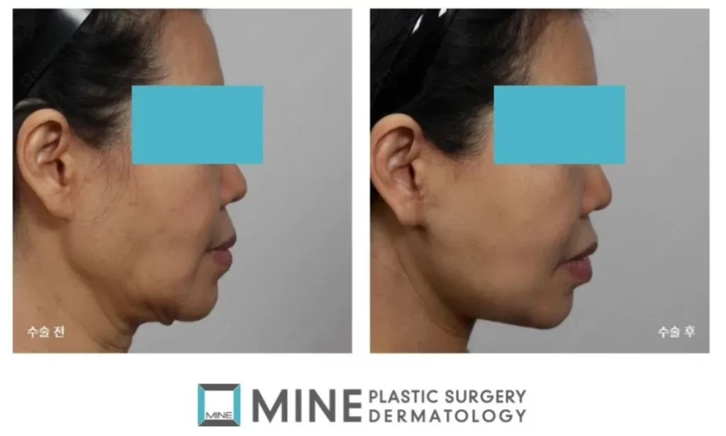Complete Neck Lift Surgery Guide | MINE Plastic Surgery