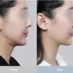 Will There Be Functional Problems After Submandibular Gland Removal ...