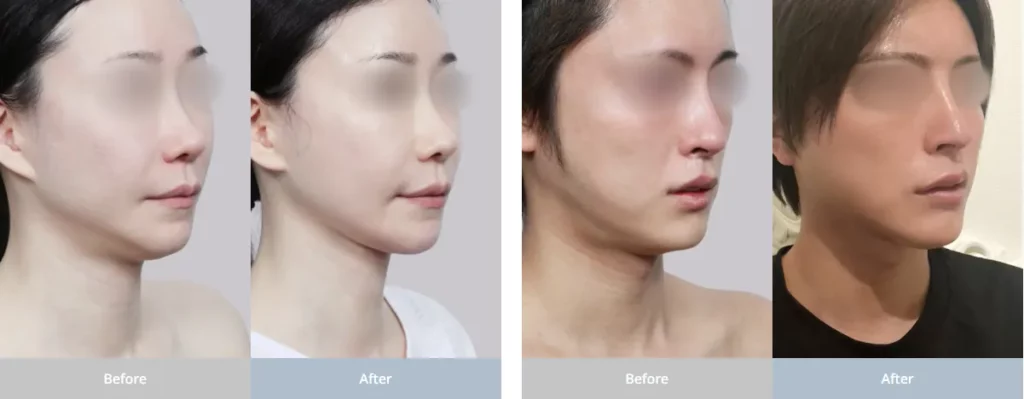 Saliva Gland Reduction Korea: Before and After Results That Transform Your Facial Profile | MINE ...