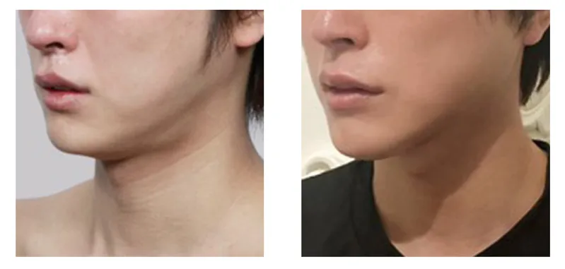 Will There Be Functional Problems After Submandibular Gland Removal ...