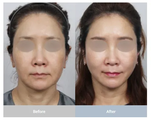 Mini Facelift Complete Guide: From Principle to Recovery | MINE Plastic ...