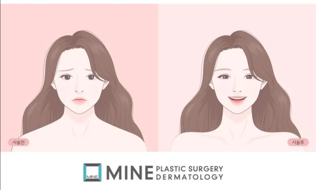 Complete Guide to Trapezius Botox Prices: Latest Cost Insights & How to ...