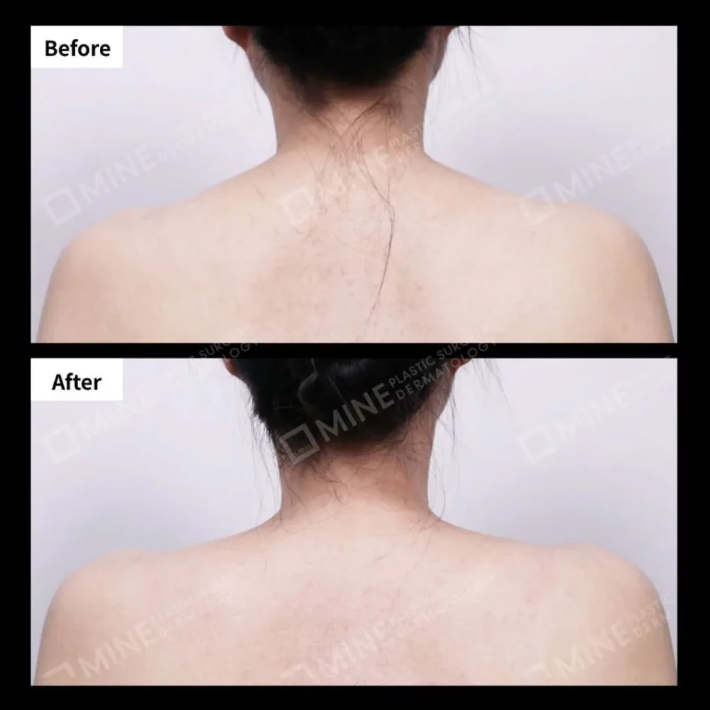 Complete Guide to Trapezius Botox Prices: Latest Cost Insights & How to ...