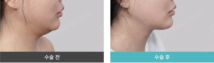 Why Does Skin Turn Hard After Surgery? Understanding Post-Operative ...